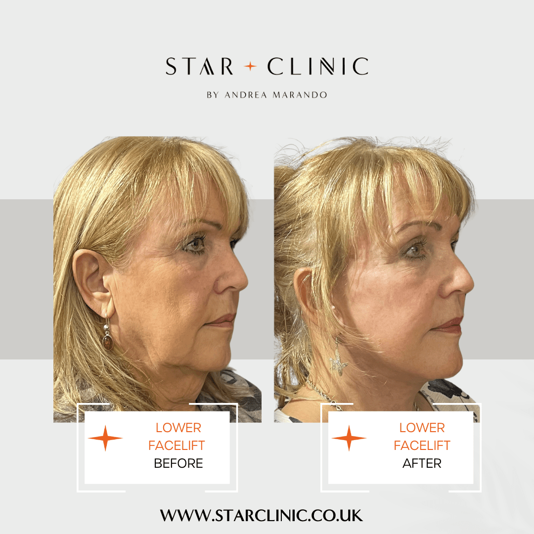 Facelift vs. Botox - Which is Best for You? - Advanced Plastic Surgery ...